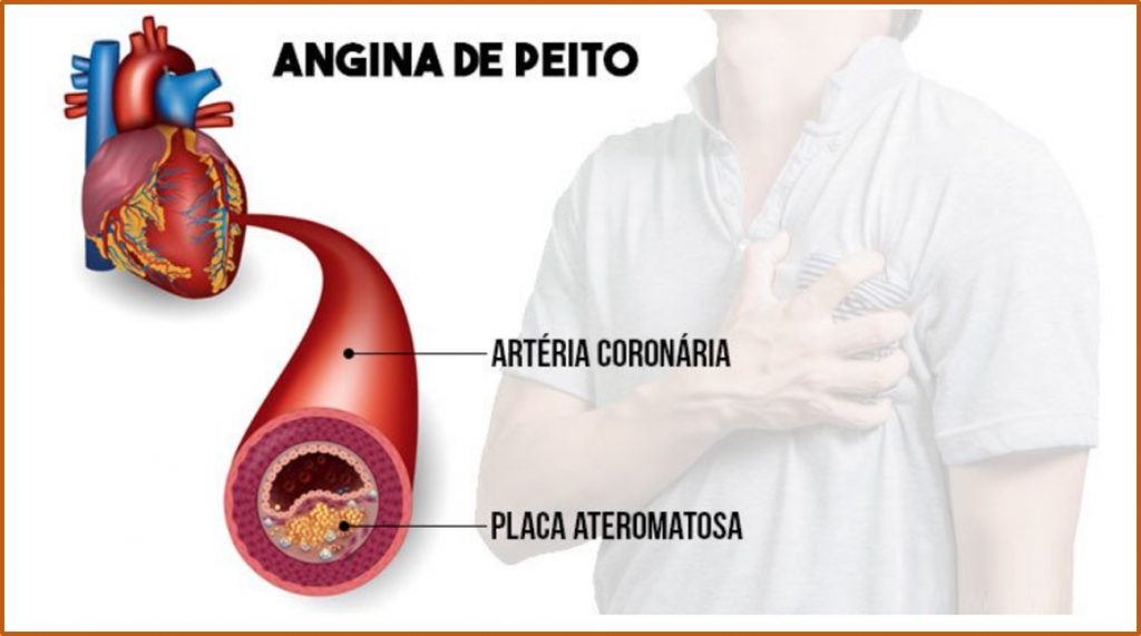Angina | Biblioteca Virtual em Saúde MS