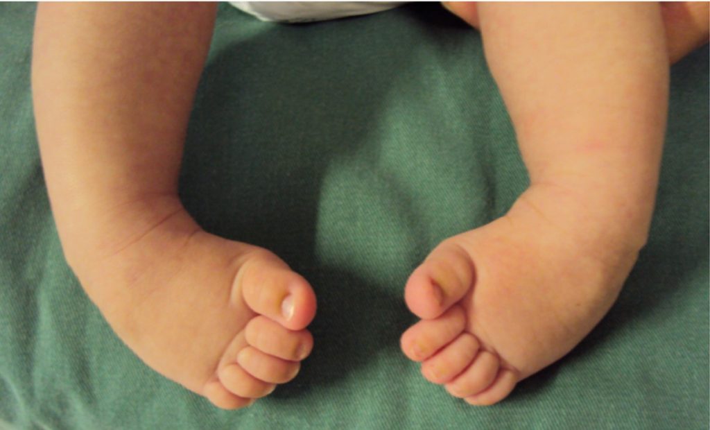 03/6 – Dia Mundial do Pé Torto Congênito | Biblioteca Virtual em Saúde MS